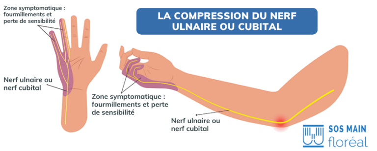 Syndrome du canal de Guyon à vélo : compression du nerf ulnaire